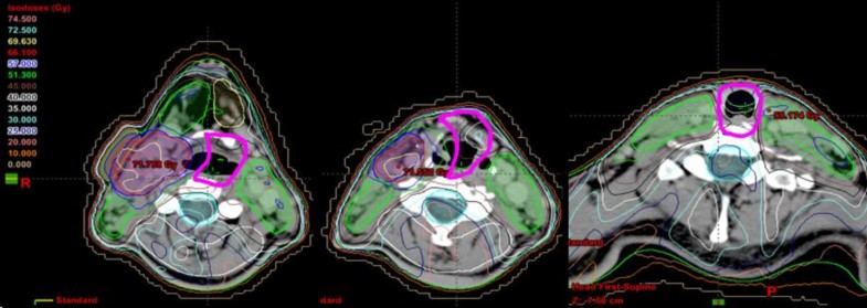 Dysphagia in head and neck cancer patients following intensity ...