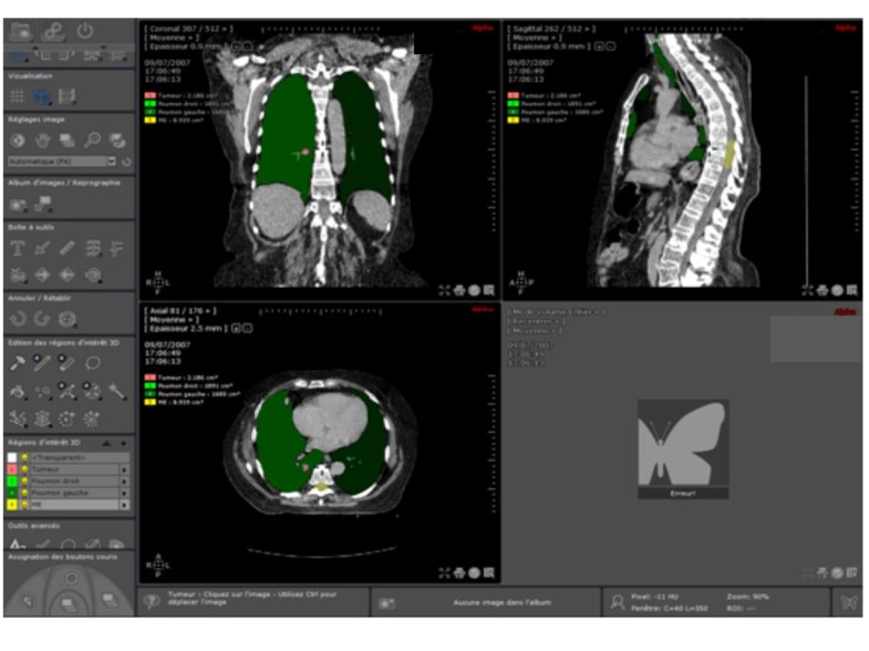Breathing adapted radiotherapy: a 4D gating software for lung cancer ...