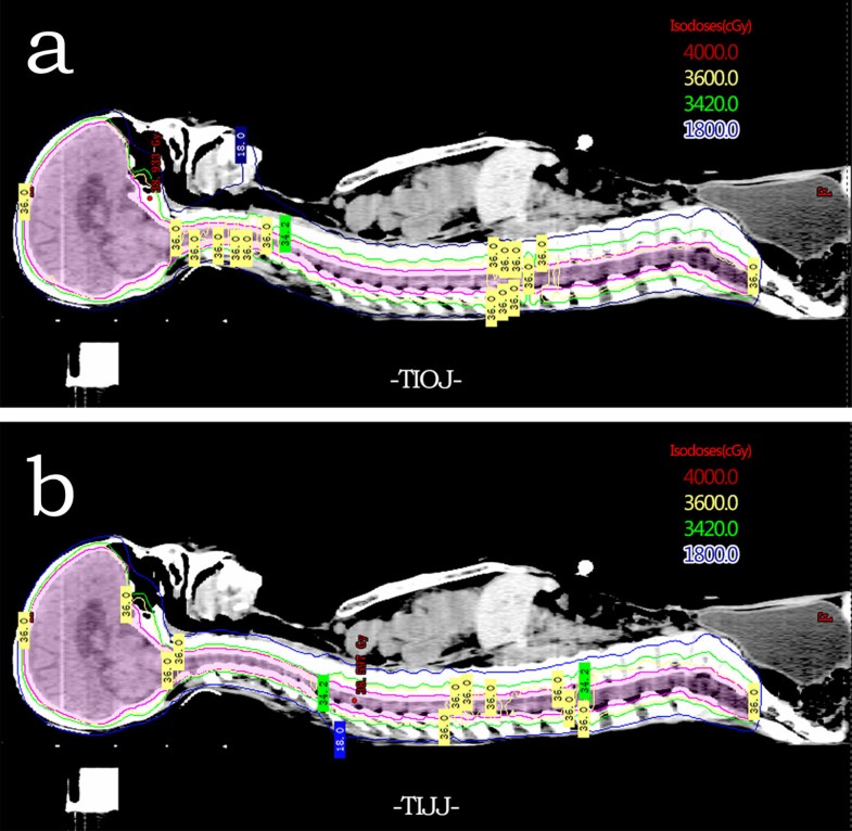 A simple approach of three-isocenter IMRT planning for craniospinal ...