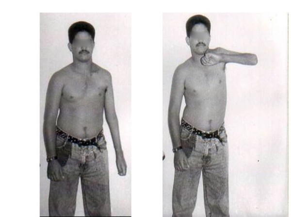 Trapezius transfer to treat flail shoulder after brachial plexus palsy ...