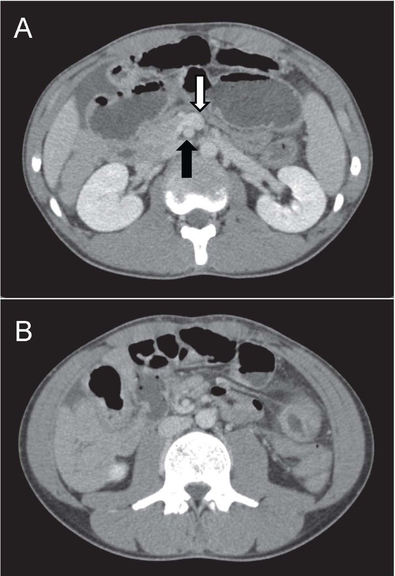 Successful treatment of a 14-year-old patient with intestinal ...