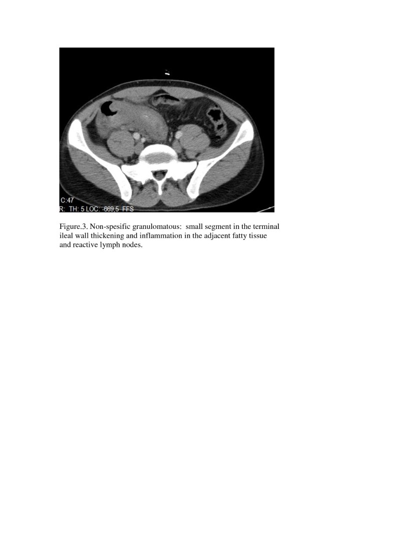Emergency right hemicolectomy for inflammatory cecal masses mimicking ...