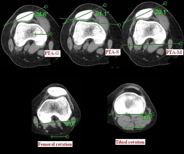 Different effects of femoral and tibial rotation on the different ...