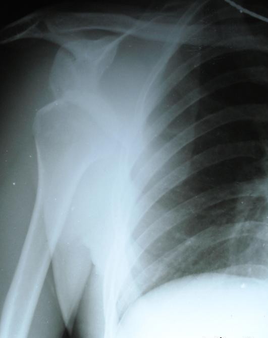 Unusual inferior dislocation of shoulder: reduction by two-step ...