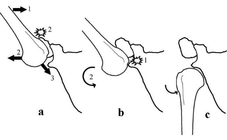 Unusual inferior dislocation of shoulder: reduction by two-step ...