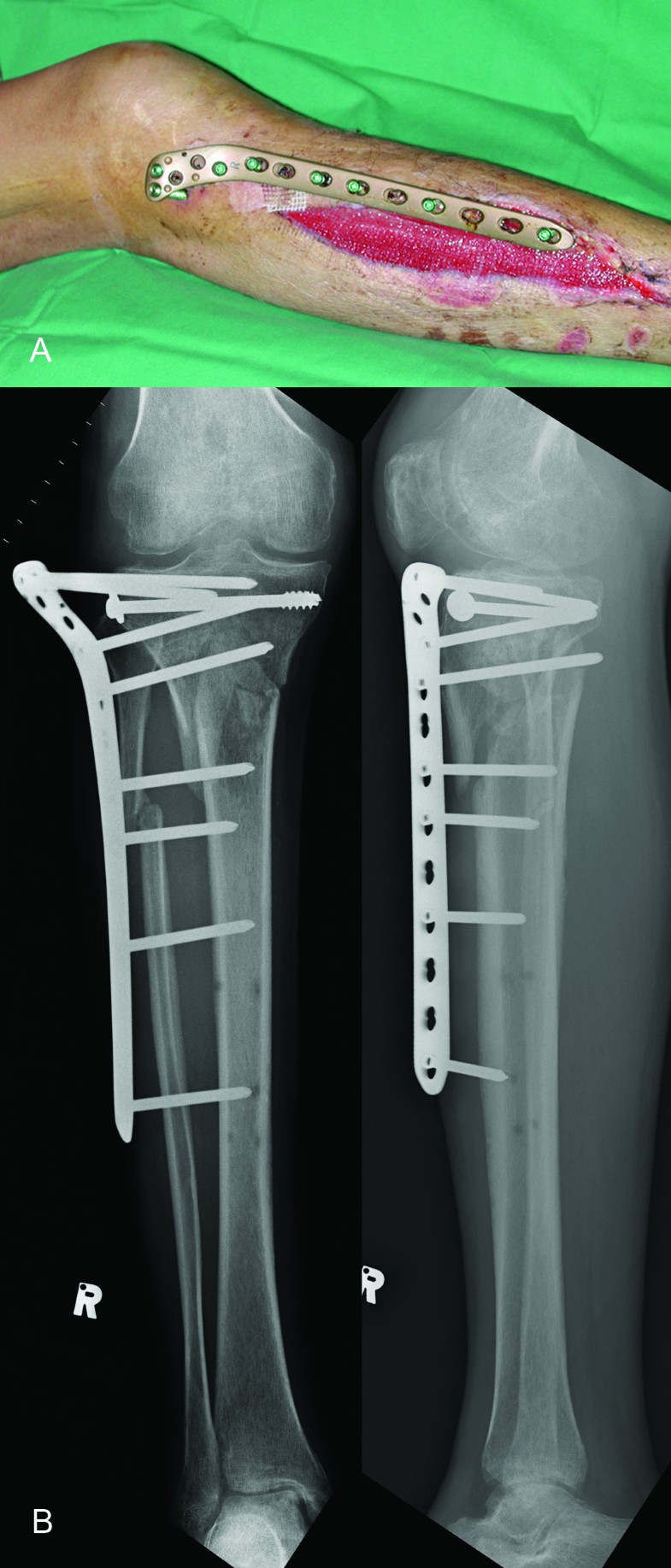 LCP external fixation - External application of an internal fixator ...