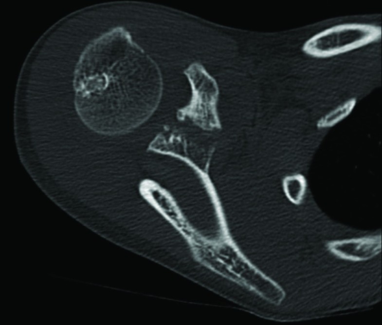 Base of coracoid process fracture with acromioclavicular dislocation in ...