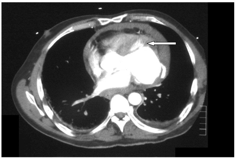 Sutureless off-pump repair of post-infarction left ventricular free ...