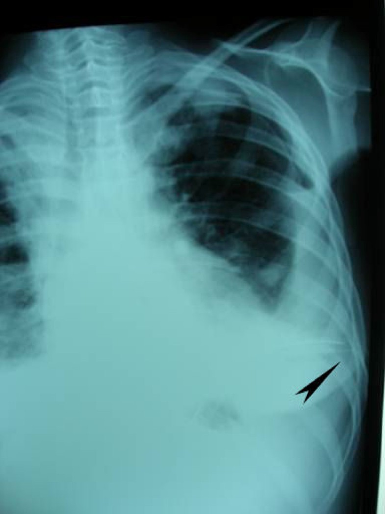 A novel and safe technique in closed tube thoracostomy | Journal of ...