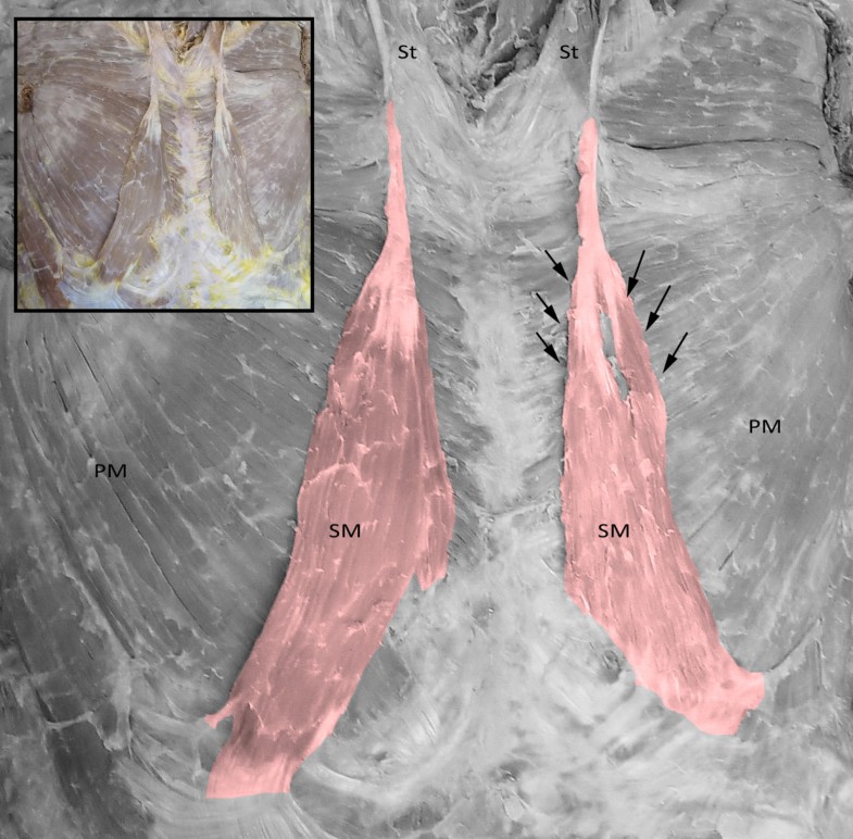 Sternalis muscle: an underestimated anterior chest wall anatomical ...