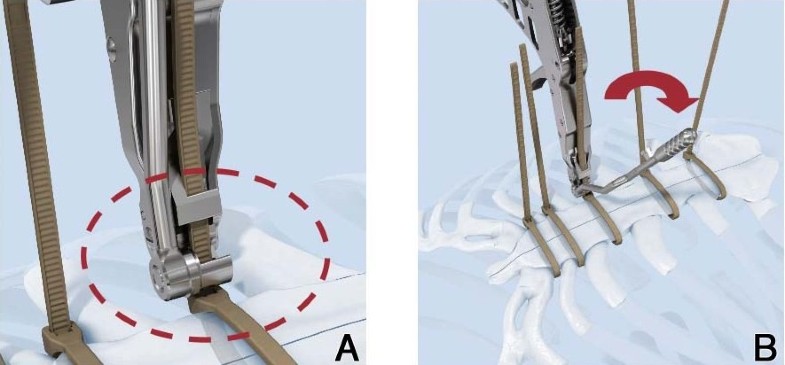 A new cable-tie based sternal closure system: description of the device ...