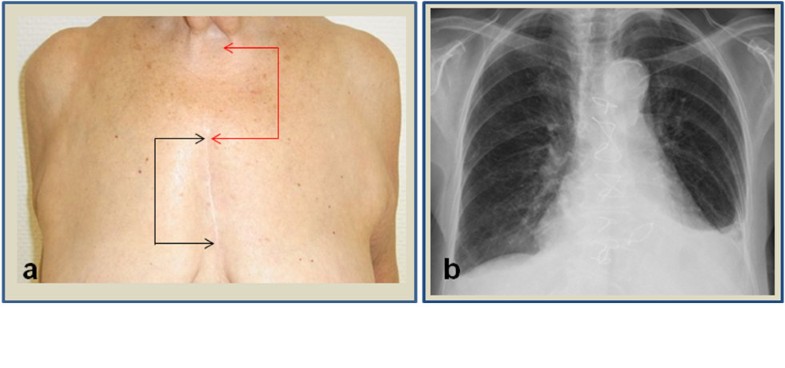 Minimal access median sternotomy for aortic valve replacement in ...