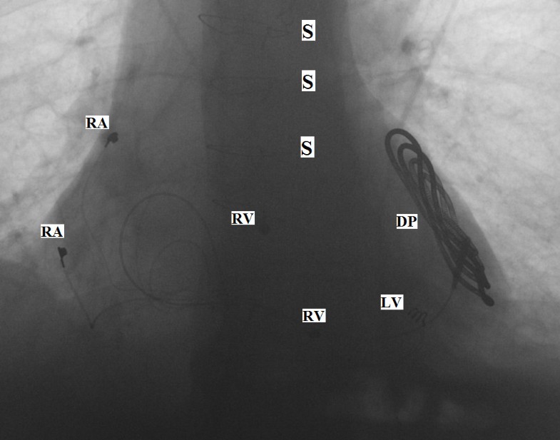 Surgical implantation of a biventricular pacing system via lower half ...