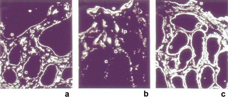 Intestinal epithelial dysplasia (tufting enteropathy) | Orphanet ...