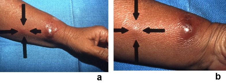 Sweet's syndrome – a comprehensive review of an acute febrile ...