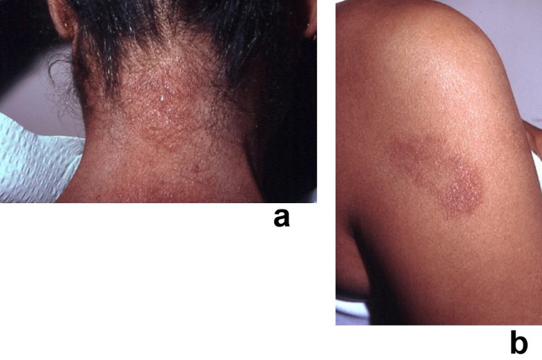 Sweet's syndrome – a comprehensive review of an acute febrile ...