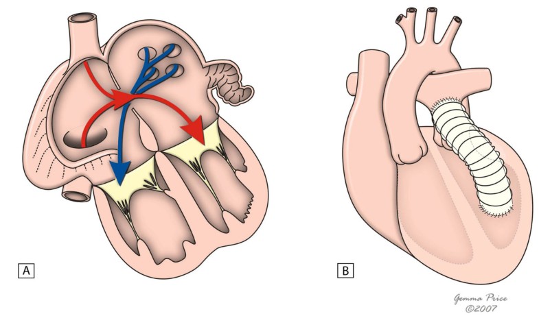 Transposition of the great arteries | Orphanet Journal of Rare Diseases ...