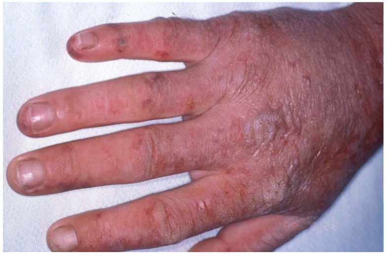 Erythropoietic protoporphyria | Orphanet Journal of Rare Diseases ...