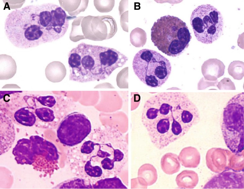 Description and outcome of a cohort of 8 patients with WHIM syndrome ...
