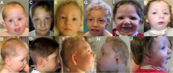Oto-facial syndrome and esophageal atresia, intellectual disability and ...