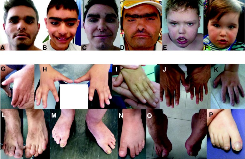 X-linked intellectual disability type Nascimento is a clinically ...