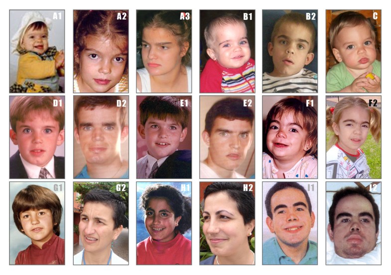 Natural history of Sanfilippo syndrome in Spain | Orphanet Journal of ...