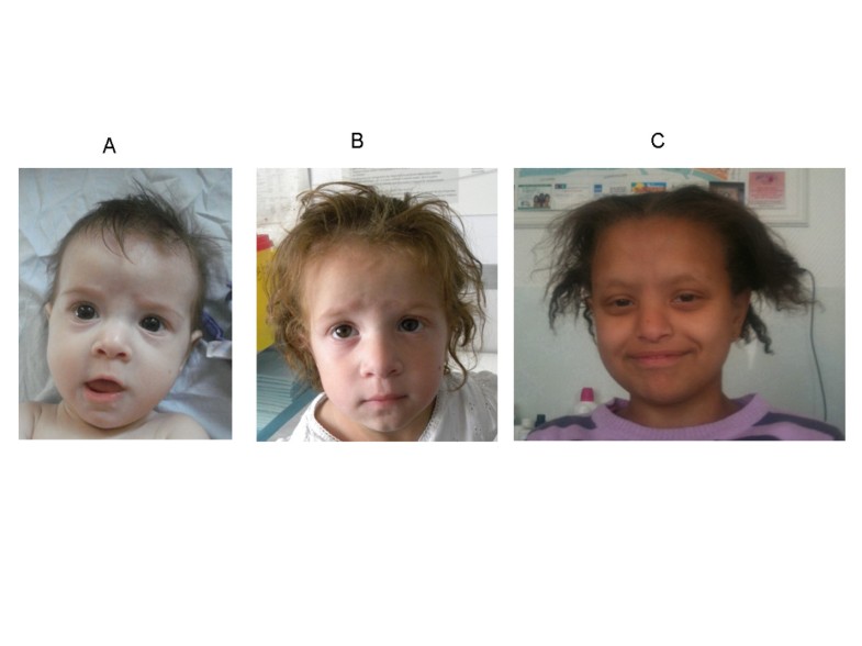 Syndromic diarrhea/Tricho-hepato-enteric syndrome | Orphanet Journal of ...