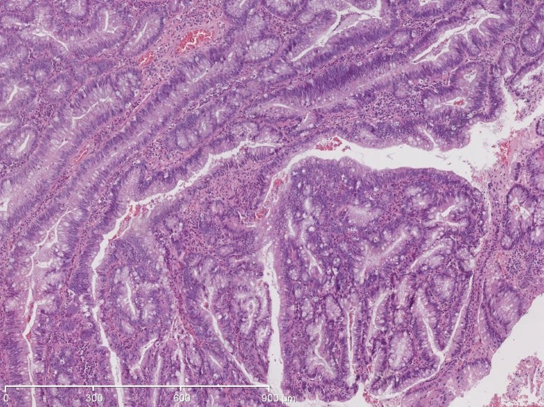 Hamartomatous polyposis syndromes: A review | Orphanet Journal of Rare ...