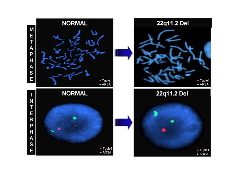 Seizures as the first manifestation of chromosome 22q11.2 deletion ...