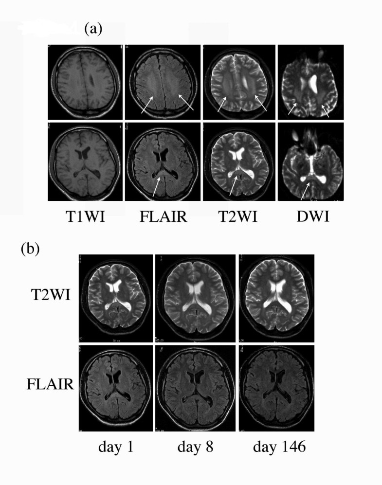 A reversible lesion of the corpus callosum splenium with adult ...
