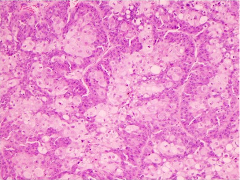 Sebaceous Carcinoma Of The Skin Of The Breast A Case Report Journal