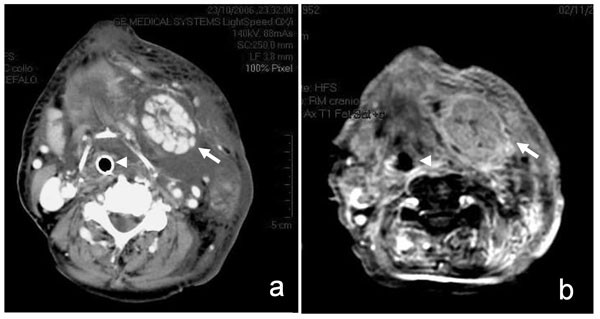 Massive facial edema and airway obstruction secondary to acute ...