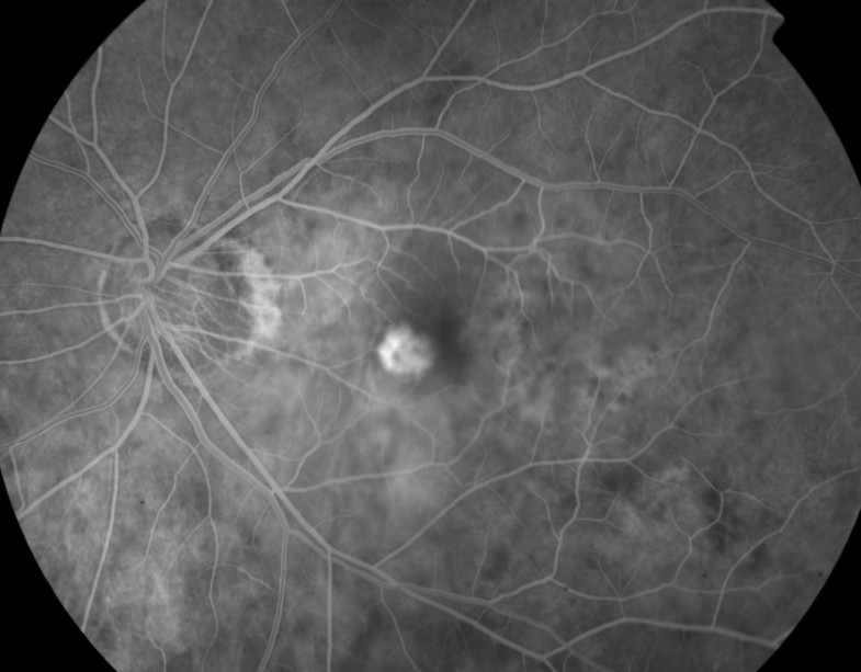 Long-term remission of myopic choroidal neovascular membrane after ...