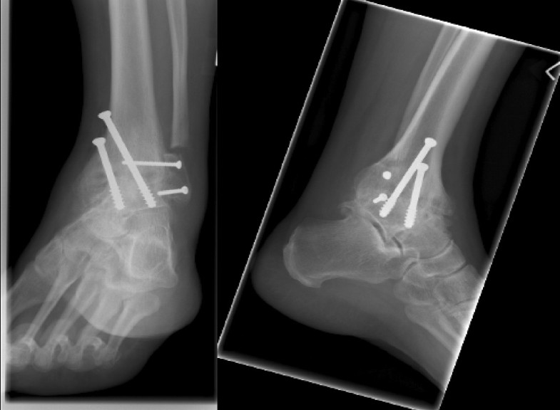 Popliteal block with transfibular approach in ankle arthrodesis: a case ...