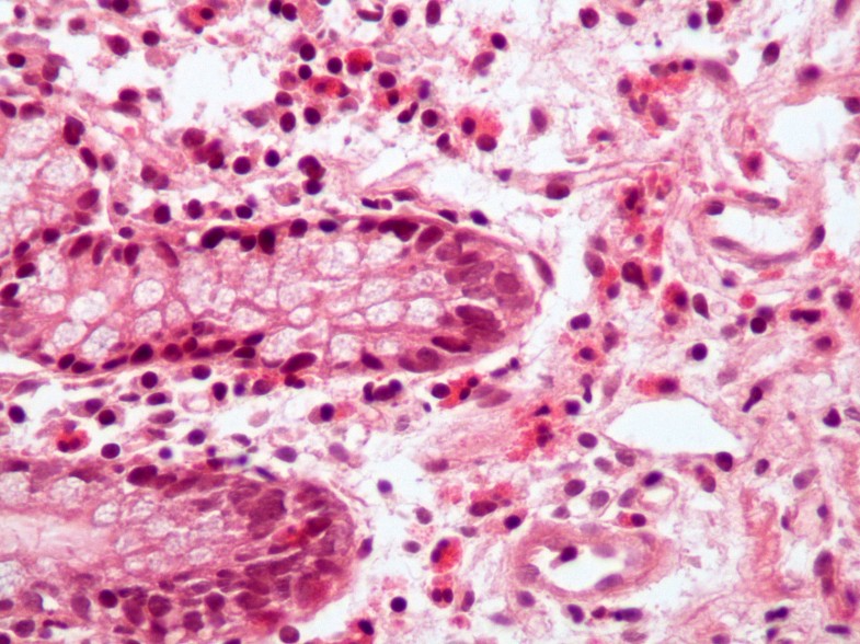 Systemic lupus erythematosus presenting with eosinophilic enteritis: a ...