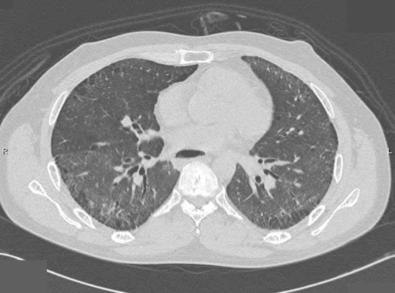 Spontaneous pneumothorax from cryptococcal pneumonia in systemic ...
