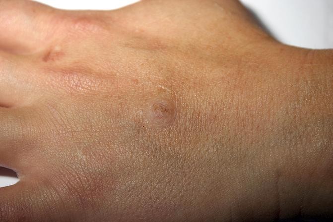 Managing the risk of cancer in Cowden syndrome: a case report | Journal ...