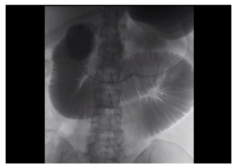A rare case of small bowel volvulus after jenjunoileal bariatric bypass ...