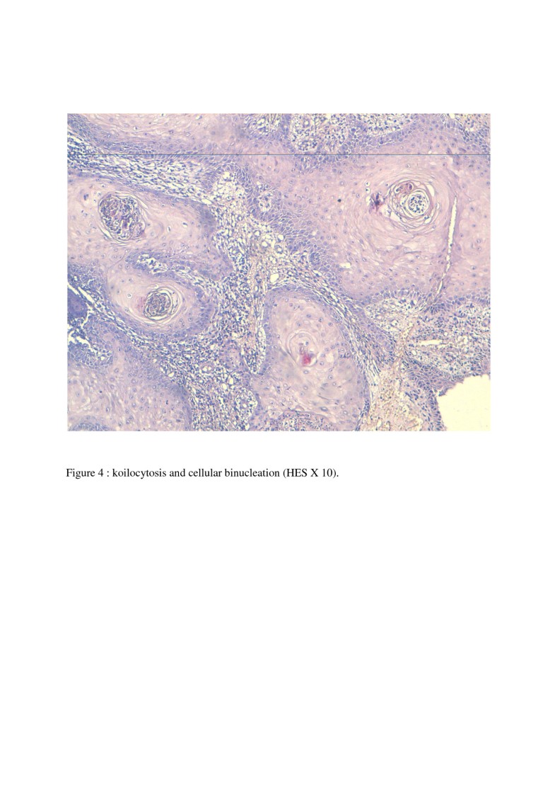 Verrucous carcinoma arising in an extended giant condyloma acuminatum ...