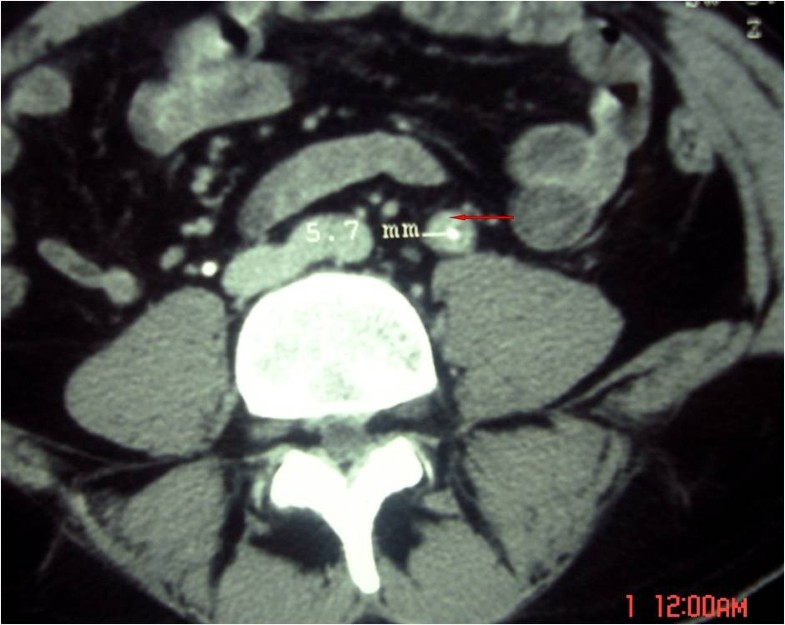 Pseudotumoral tuberculous ureteritis: a case report | Journal of ...