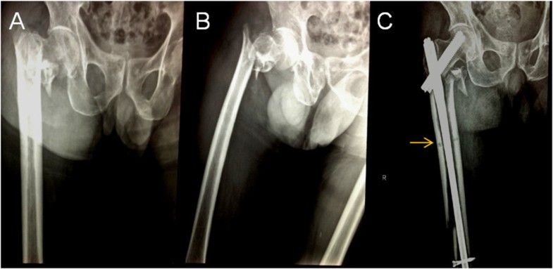Implantation of INTERTAN™ nail in four patients with intertrochanteric ...