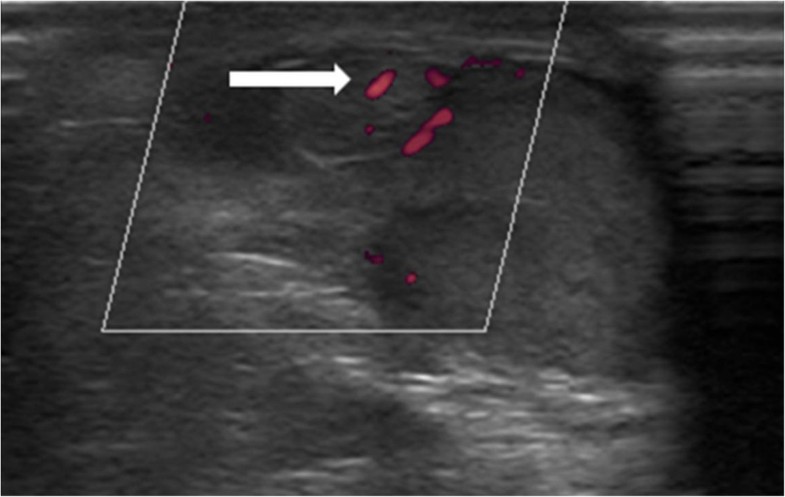 Polyorchidism Two Case Reports And A Review Of The Literature