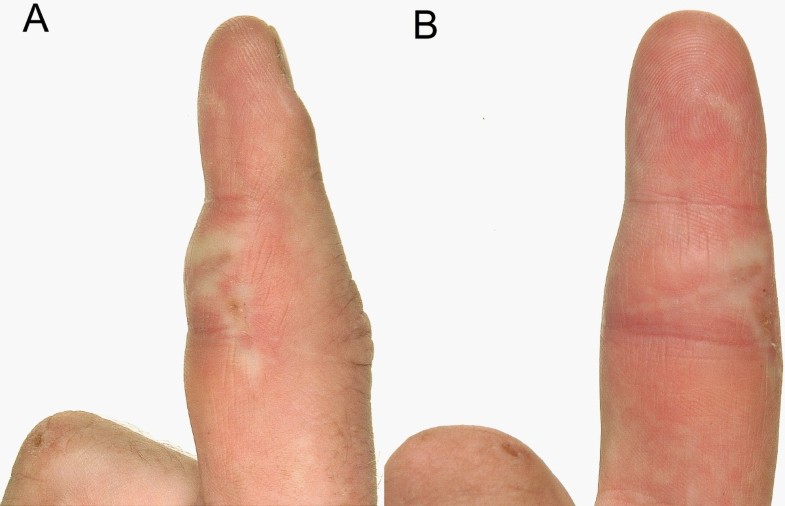 Scar sarcoidosis on a finger mimicking a rapidly growing soft tissue ...