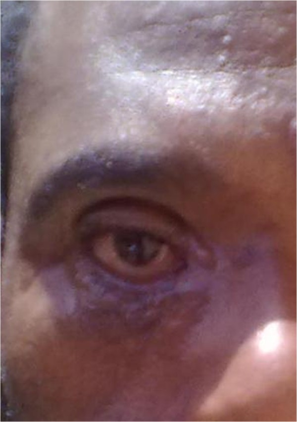 Periocular cutaneous anthrax in Jimma Zone, Southwest Ethiopia: a case ...