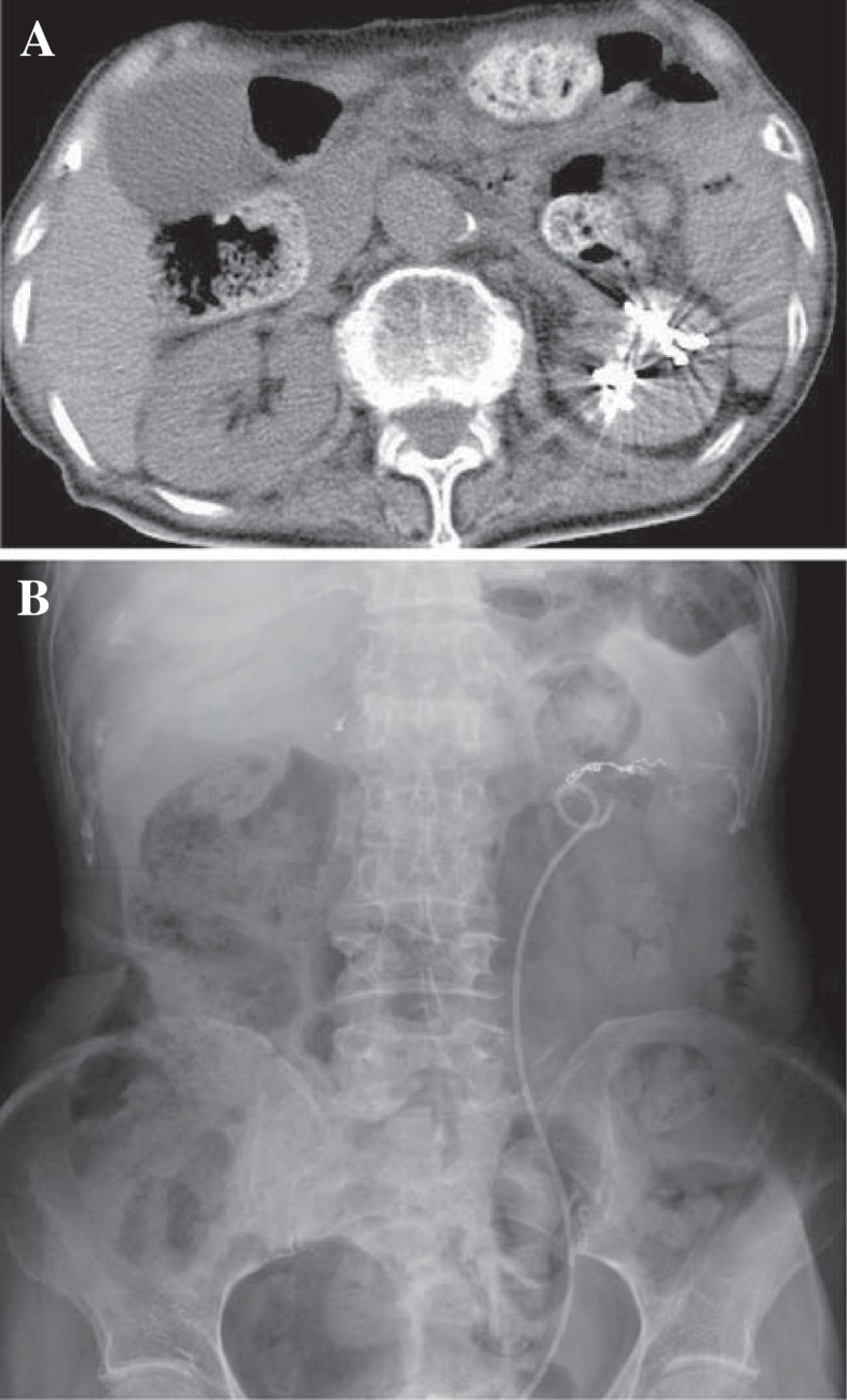 Ruptured renal arteriovenous malformation successfully treated by ...