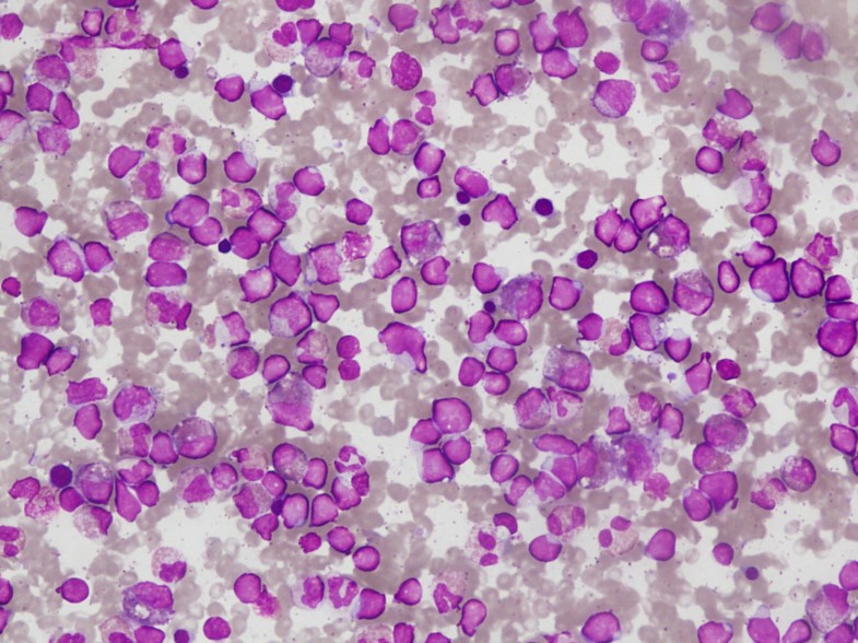 Adult B lymphoblastic leukaemia/lymphoma with hypodiploidy (-9) and a ...
