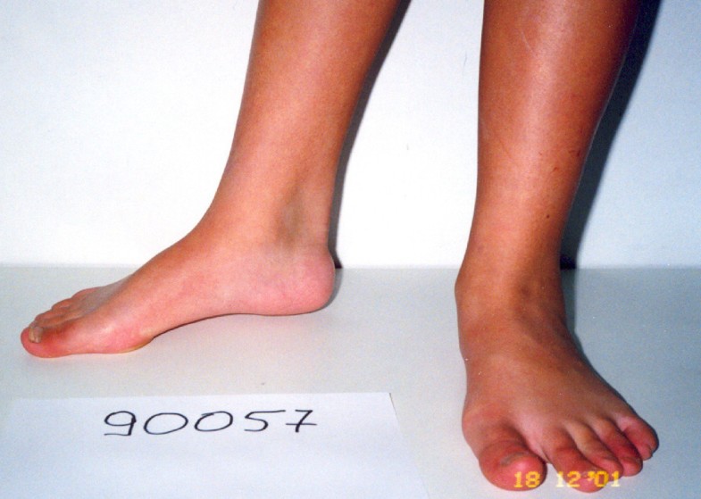 Split tendon transfers for the correction of spastic varus foot ...