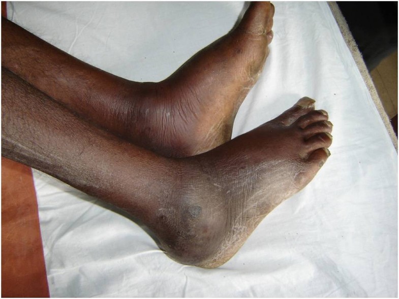 Burkholderia pseudomallei infection in a patient with diabetes ...