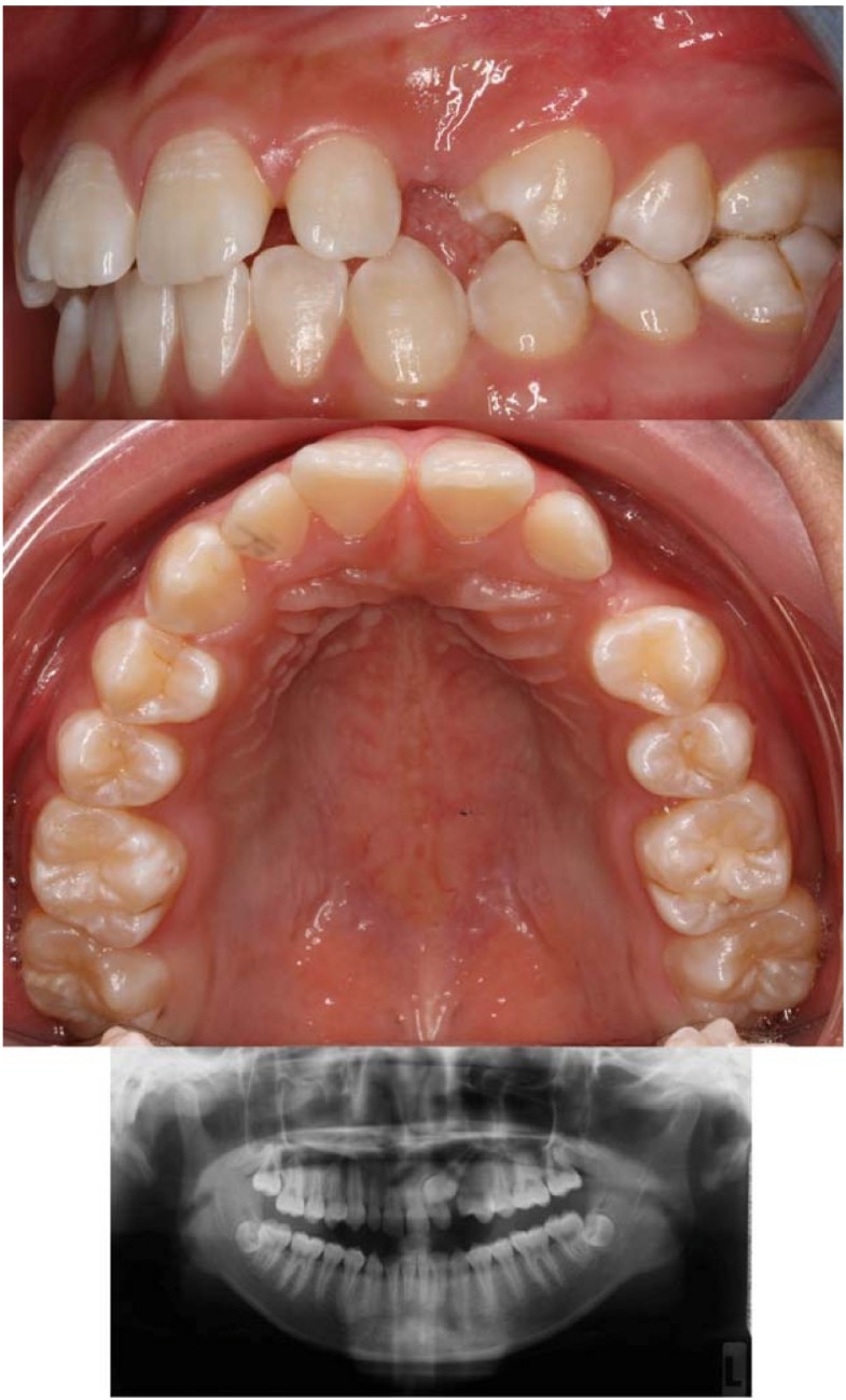 Orthodontic traction of impacted canine using magnet: a case report ...