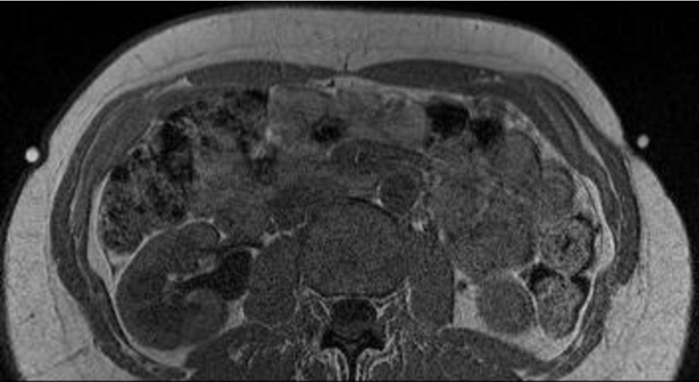 Relapsing insulin-induced lipoatrophy, cured by prolonged low-dose oral ...